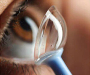 Contact Lens - Dr. Shroff's Charity Eye Hospital
