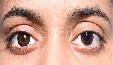 Department of Ocular Oncology & Oculoplasty Services - Dr. Shroff's ...